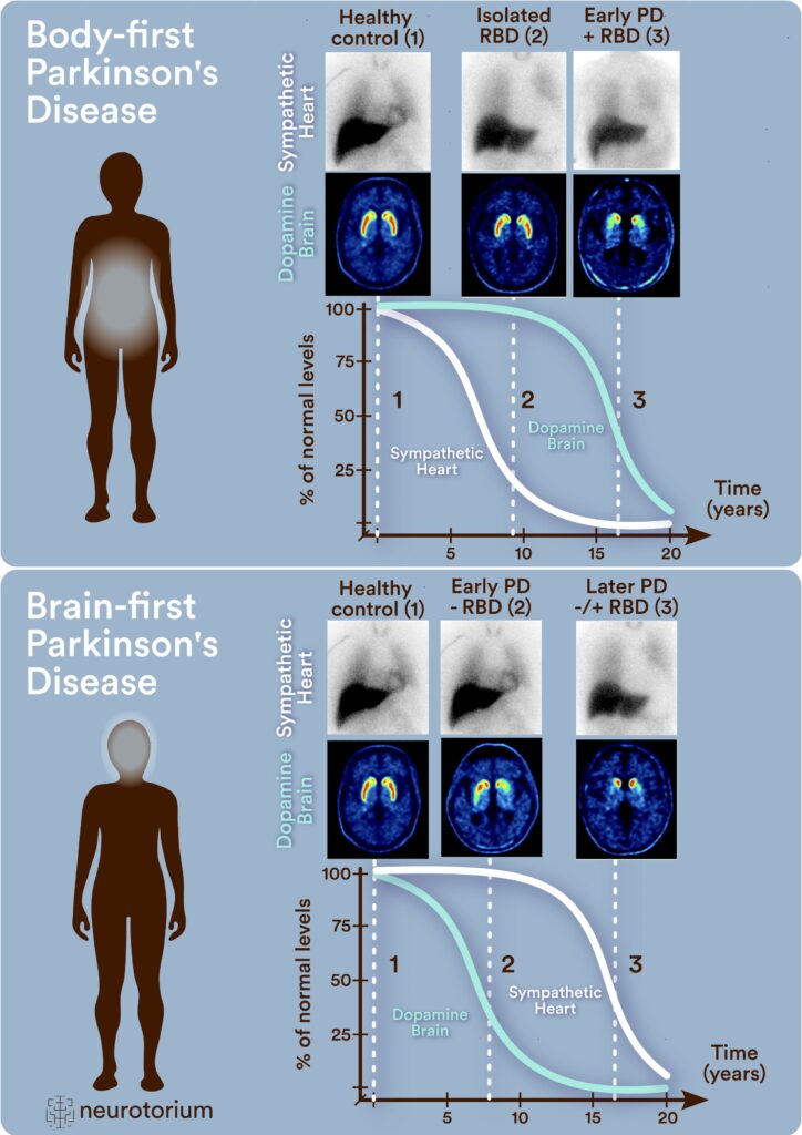 Parkinson's Disease and Braak stages - Neurotorium