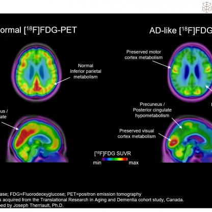 Summary of high-performing CSF and plasma biomarkers for the diagnosis ...