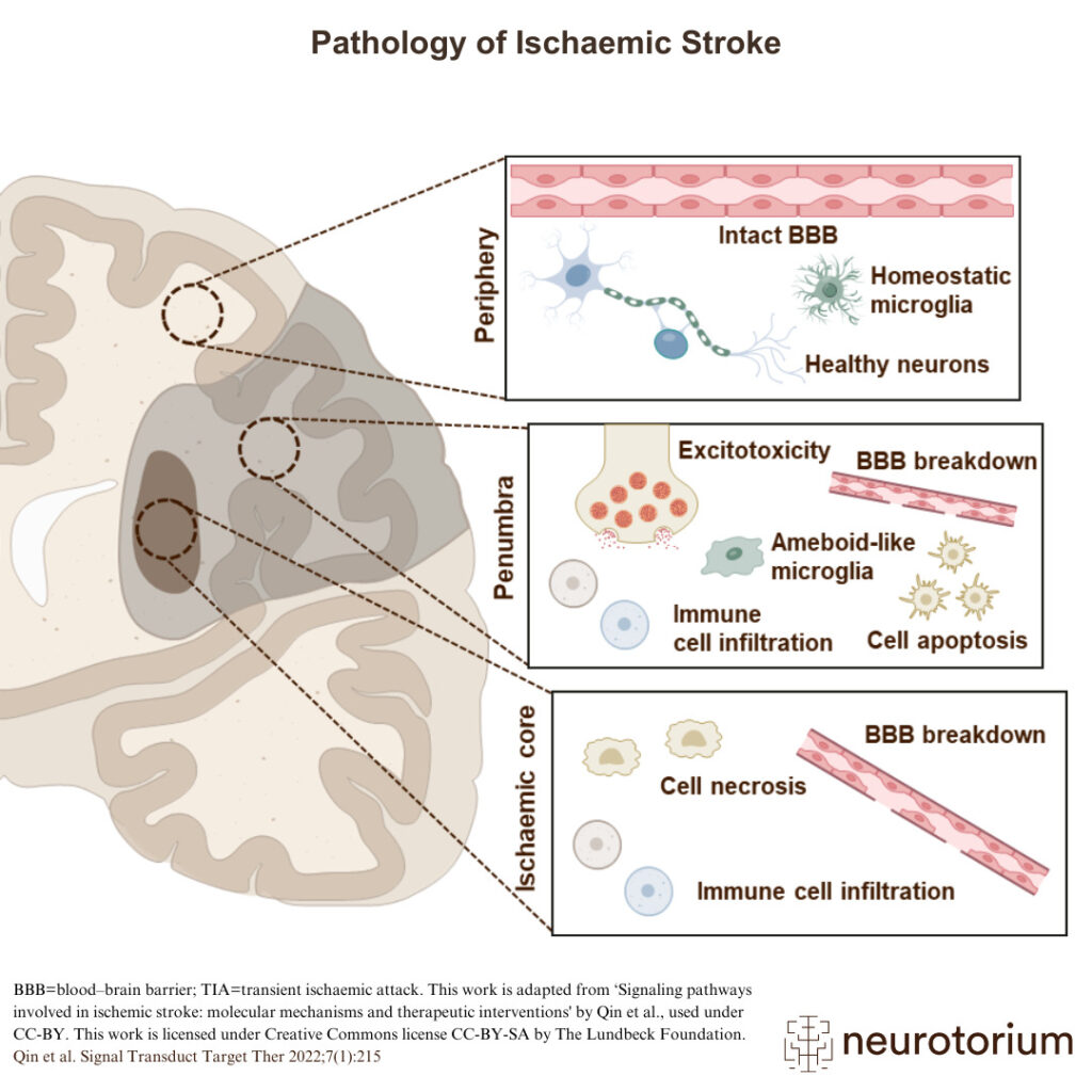 Mechanisms behind Ischaemic Stroke - Neurotorium