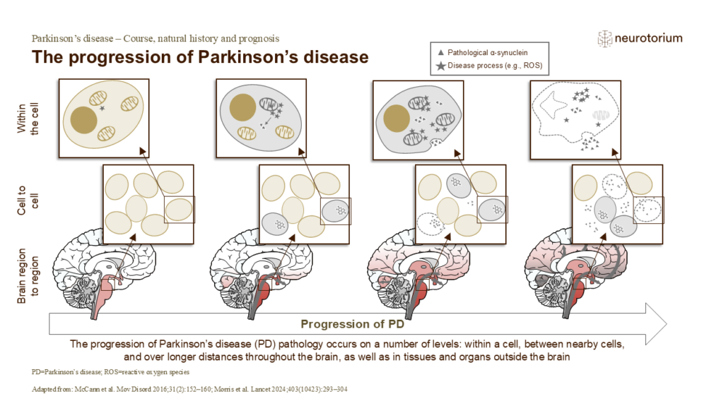 The progression of Parkinson’s disease - Neurotorium