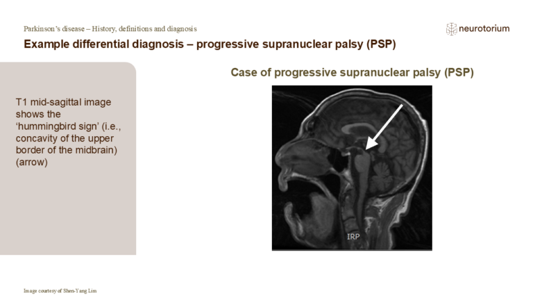 Example differential diagnosis – progressive supranuclear palsy (PSP ...